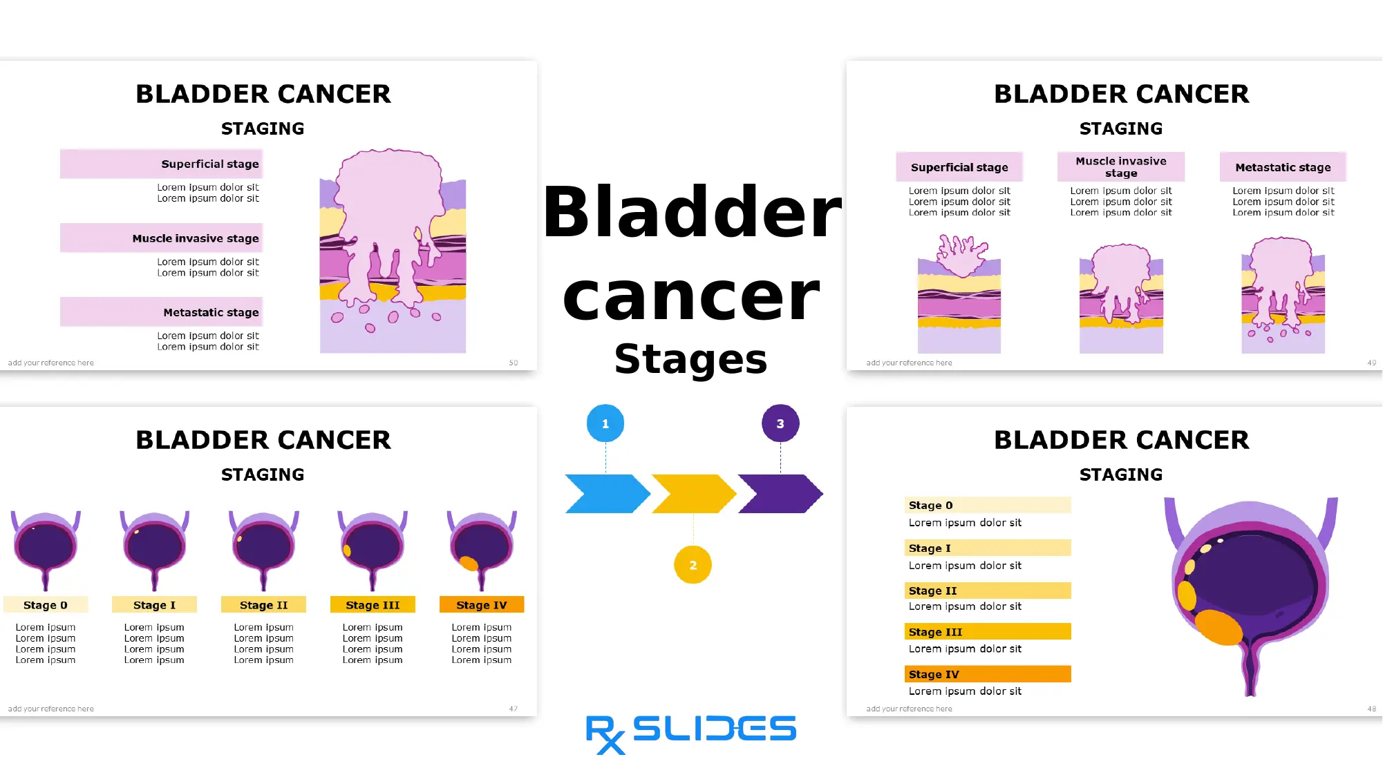 Download Bladder Cancer PowerPoint Template|RxSlides